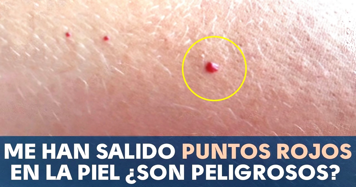Puntos rojos en la piel? Tienes que saber las razones antes de que sea ...